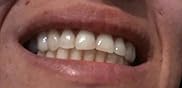 CREADENT Kit for Replacing a Missing Tooth with a Temporary Cosmetic ...