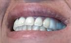 CREADENT Kit for Replacing a Missing Tooth with a Temporary Cosmetic ...