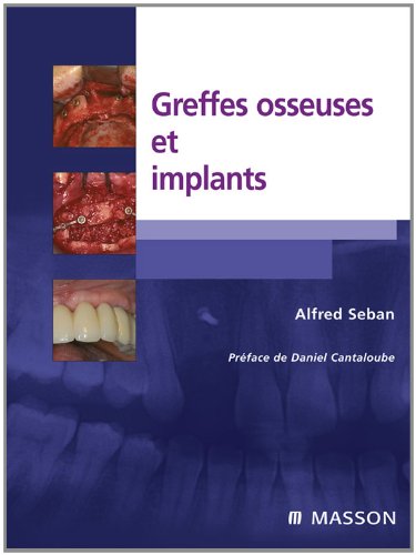 Implants - Gbs