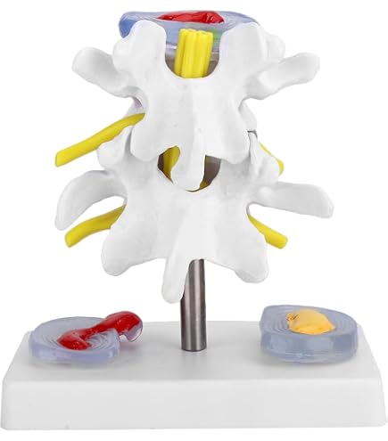 Disc Degeneration Stages Set. Flat Spine Vertebrae Anatomy Scheme ...