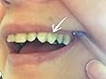 CREADENT Kit for Replacing a Missing Tooth with a Temporary Cosmetic ...
